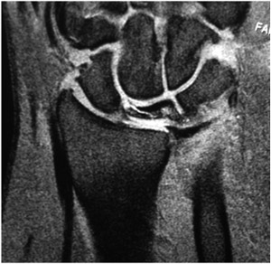 Kienbock's disease as a rare cause of wrist pain.